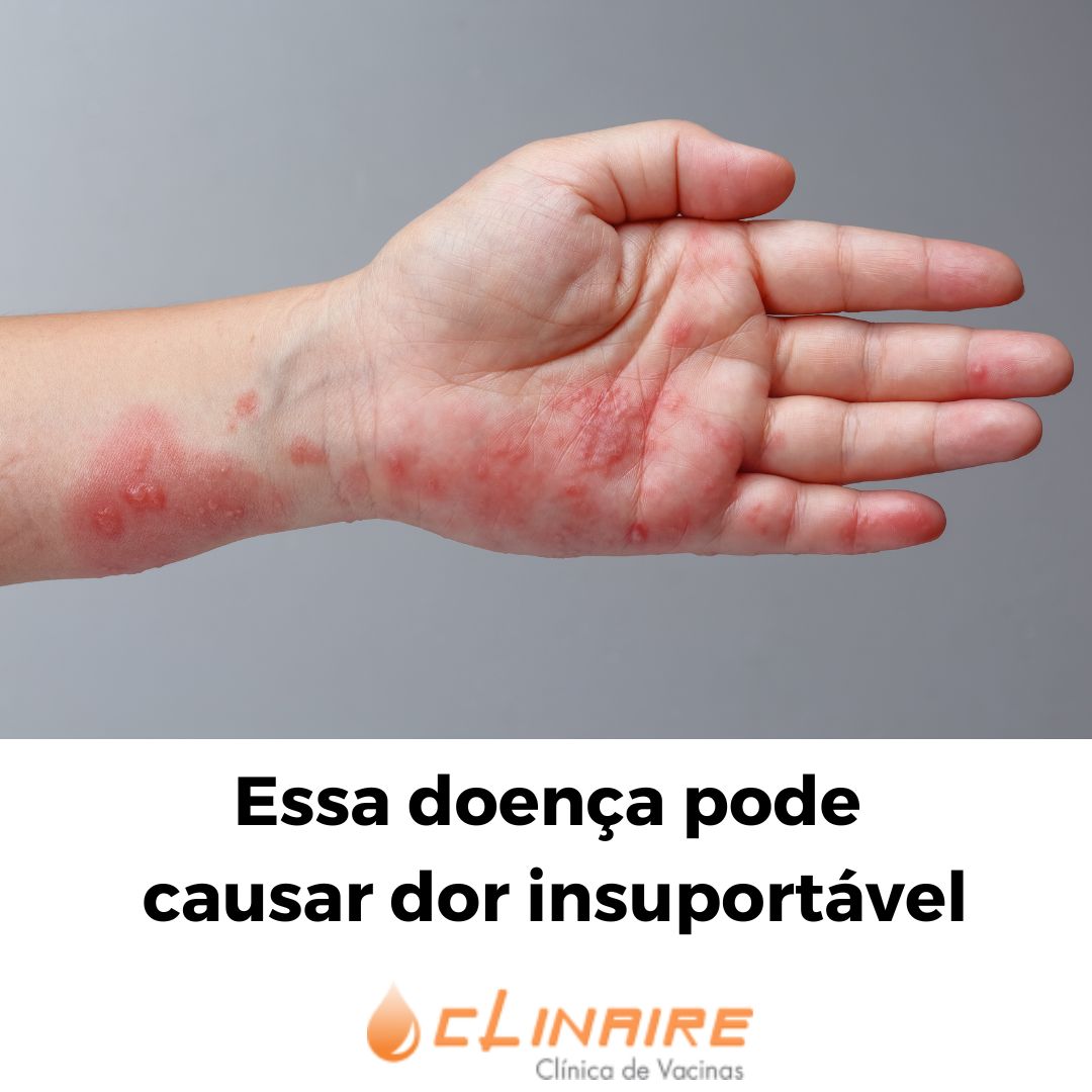herpes zóster | Clinaire - Clínica de vacinação e alergia - Rio de ...